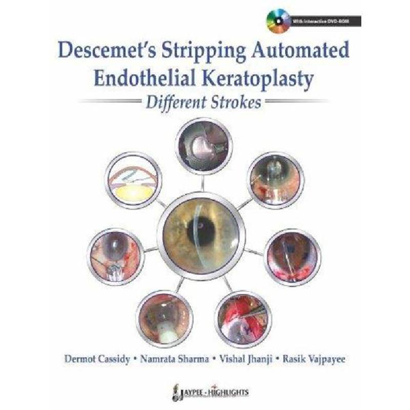 Stripping Automated Endothelial Keratoplasty Dermot Cassidy - Jarir.com KSA